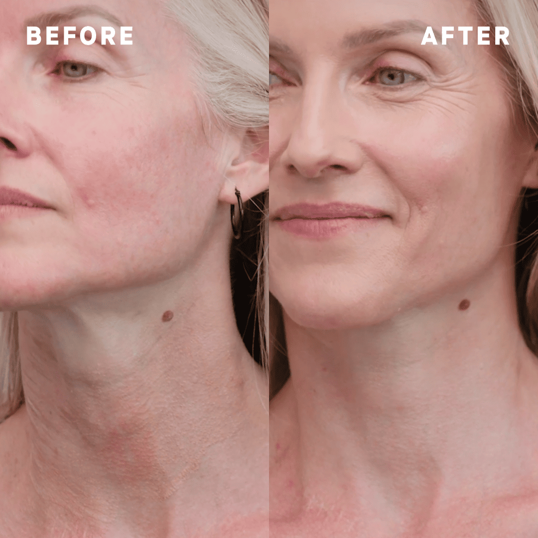 High Profile Neck Treatment | IL MAKIAGE